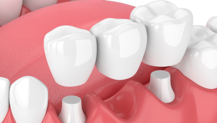 Types of Dental Bridges: Find the Right One for You